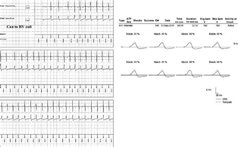 A Representative Electrogram Egm During Atrial Fibrillation
