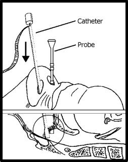 The Nasal Bridle A Useful Approach To Prevent The Dislodgement Of