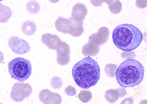 Plasma Cell Leukemia 3