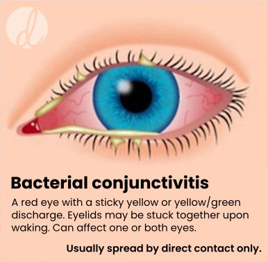 Conjunctivitis Bacterial Mucopurulent Discharge Eyelids