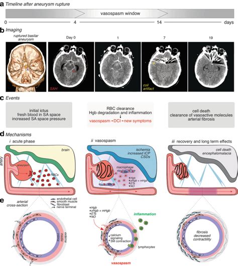 Cerebral Vasospasm Springerlink