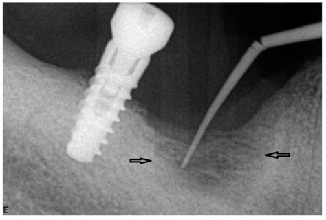 Radiolucency Remains In The Bone Socket Area September 2015 A