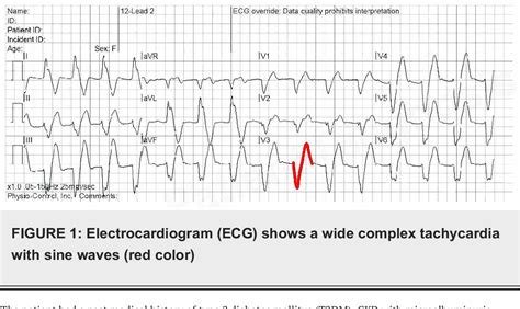 Figure 1 From Severe Persistent Hyperkalemia With Electrocardiogram