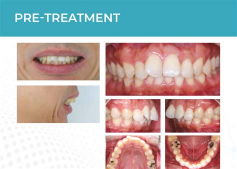 Deep Bite Midline Discrepancy Minor Crowding Trioclear™