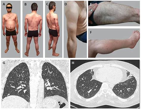Frontiers Glu20ter Variant In Plec 1f Isoform Causes Limb Girdle