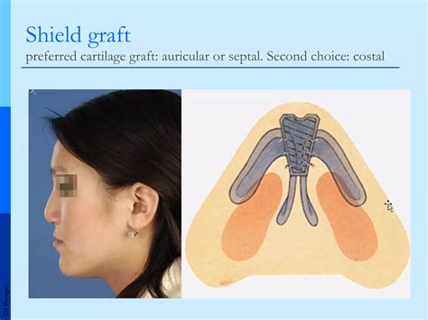 Grafts In Nasal Surgery V2 Ppt
