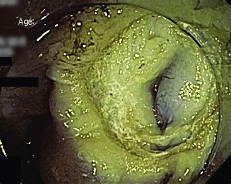 Peritoneal Defect After Full Thickness Resection Download Scientific Diagram