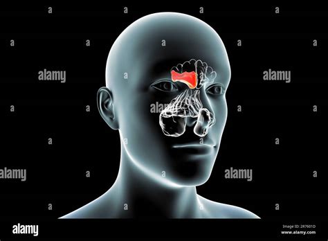 Sinusitis Computer Illustration The Sinuses Are Membrane Lined Air