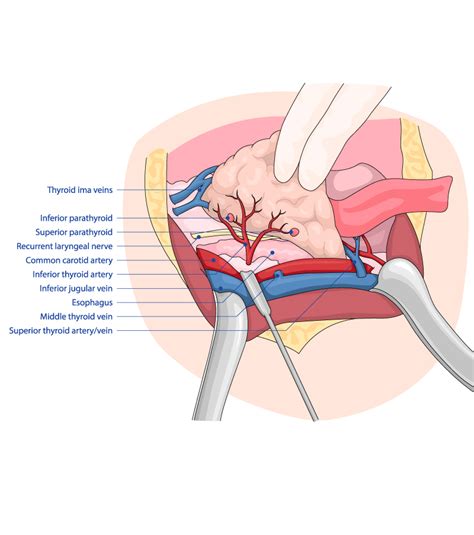 Thyroidectomy Procedure Guide Thunderbeat Open Fine Jaw Olympus