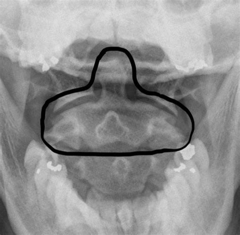 Cervical Spine Odontoid View Flashcards Quizlet