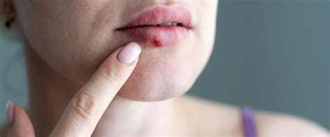Avoid Sexual Contact When Sores Are Present