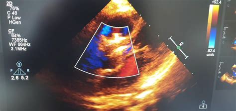 16 Years Old Boy Had Subaortic Vsd Ar Rcc Prolapse Vsd Device Closure