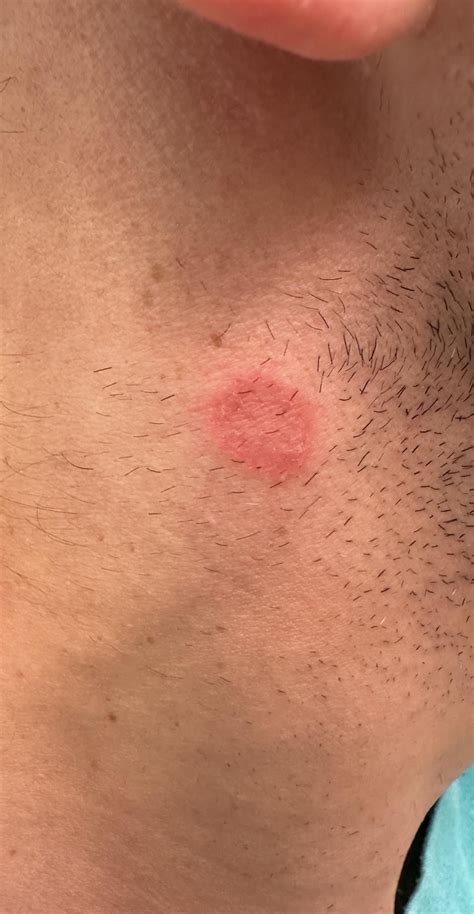 Red Circles Appear Periodically On My Face Ringworm Or Skin Irritation