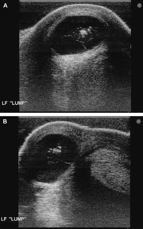 A Longitudinal Ultrasonogram Of The Swelling Showing The