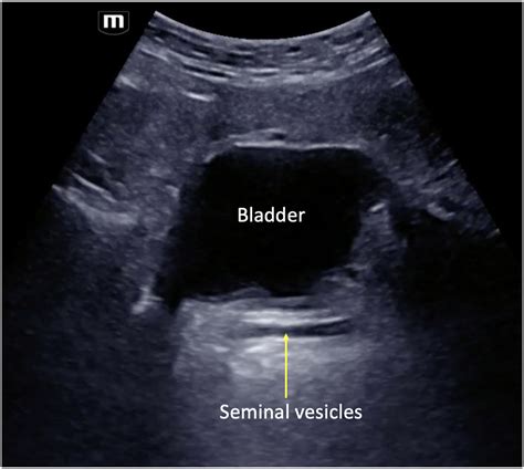 Resuscitative Ultrasound And Protocols Emergency Medicine Clinics