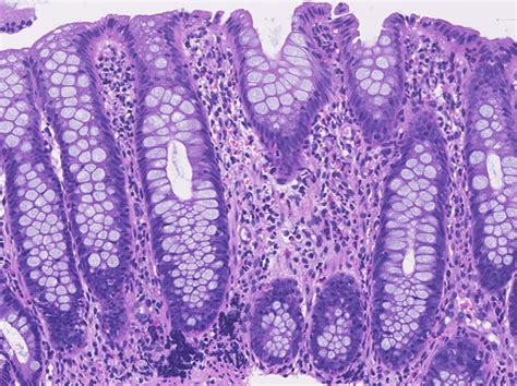 Granulomatous Variant Of Food Protein Induced Allergic Proctocolitis Pmc