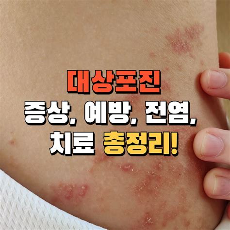 대상포진 증상 초기증상 합병증 원인 예방 전염성 치료 알아보기