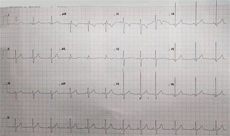 Ventricular Septal Defect Ecg