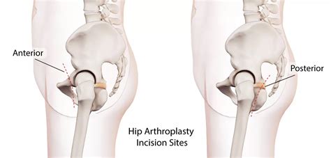 Anterior Hip Replacement Surgery Procedure And Its Advantages