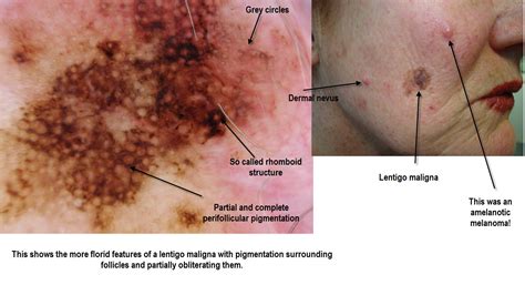 Dermoscopy Made Simple Lentigo Maligna