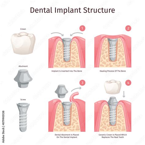 Dental Implant Structure Tooth Implantation Procedure Teeth