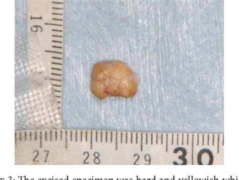 Figure 1 From A Case Of Old Calcifying Epithelioma Processed