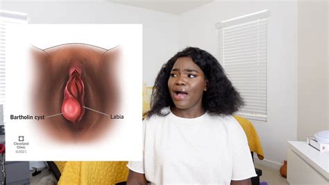 Bartholin Abscess Burst