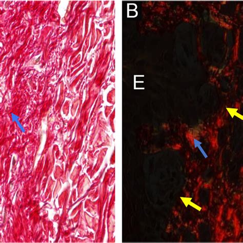 Dysplastic Nevus Syndrome Classical Dysplastic Nevus On The Left The Download Scientific