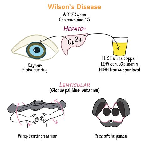 Wilsons Disease Chromosome Overview Of Wilson Disease