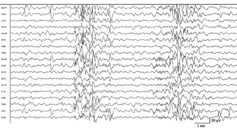 Example Of Interictal Epileptiform Discharges Ieds During Sleep A Download Scientific