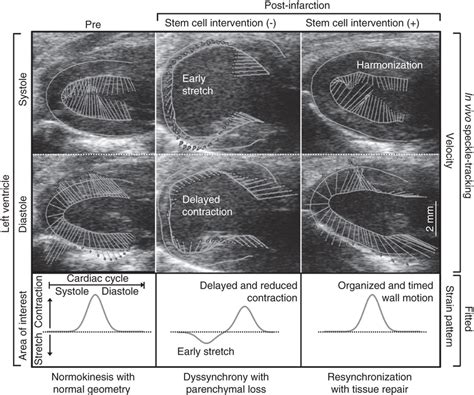 Stem Cell Intervention Rescues Disparity In Ventricular Wall Motion