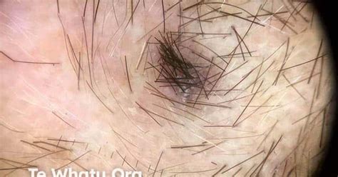 Lichen Simplex Image