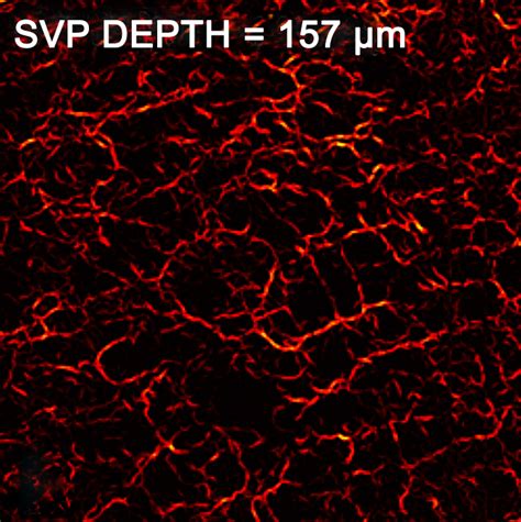 Atopic Dermatitis And Contact Dermatitis Vivosight