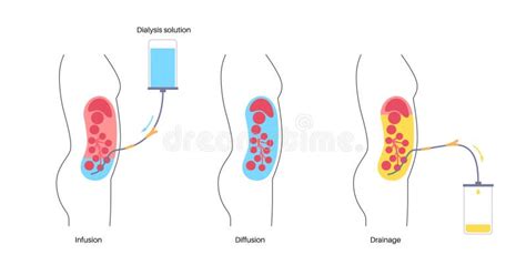 Peritoneal Dialysis Concept Stock Vector Illustration Of Ascites