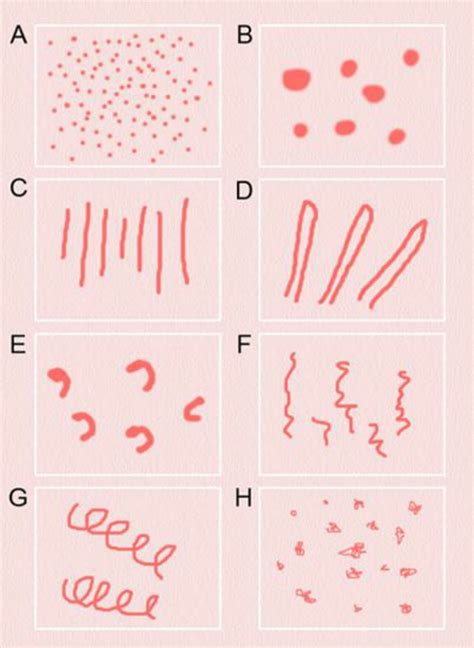 Vascular Patterns Vessels As Dots A Clods B And Linear Vessels
