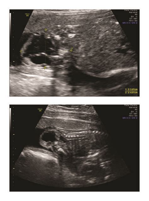 A Dimensions Of The Exophytic Mass Measuring 307 Cm In Length And Download Scientific