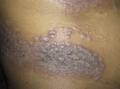 Psoriasis Experienced Differently By People Of Color Urban Health Today