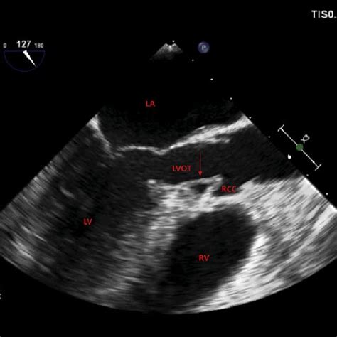 Tee Midesophageal Long Axis View Showing Successful Removal Of The Download Scientific
