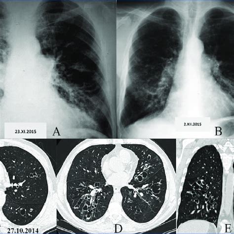 Basic Morphologic Types Of Bronchiectasis Recognized On Ct Axial Ct