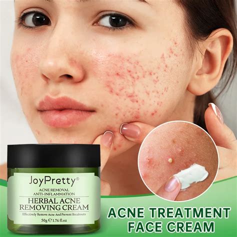 Joypretty Crema Facial Hidratante Para El Acn Tratamiento Para El