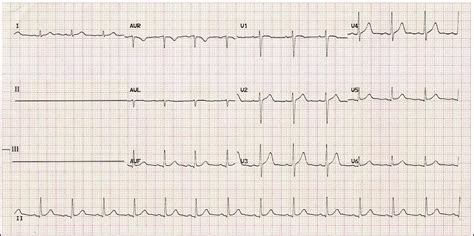 Ecg Interpretation