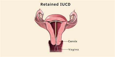 Safe Removal Of Retained Iucd By Dr Pankhuri Gautam In Jaipur