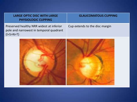 Optic Disc Evaluation Pptx