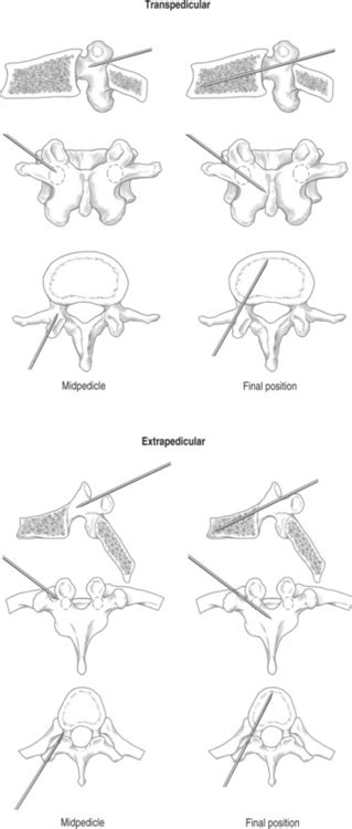 Kyphoplasty Technique Clinical Gateclinical Gate