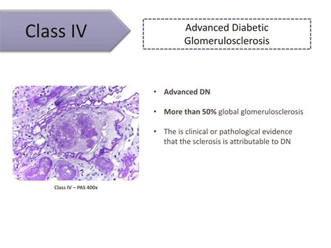 Ppt Categorization Of The Diabetic Nephropathy By Tervaert