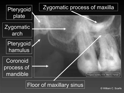 Dental Maxillary And Mandibular Anatomic Radiographic Landmarksppt 3