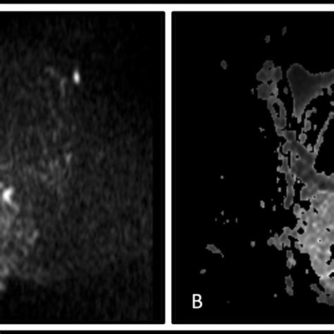 Mri Of The Pelvis Diffusion Weighted Images A And Adc Map B Download Scientific Diagram