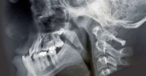 Prognatismo ¿qué Es Y Cómo Tratarlo Ramis Gandía