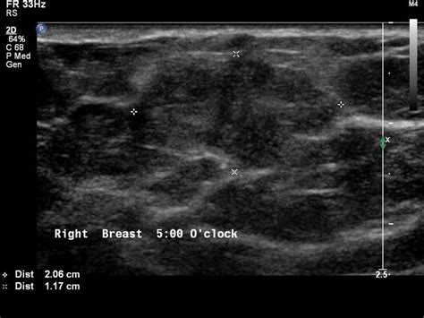 Atlas Of Breast Cancer Early Detection