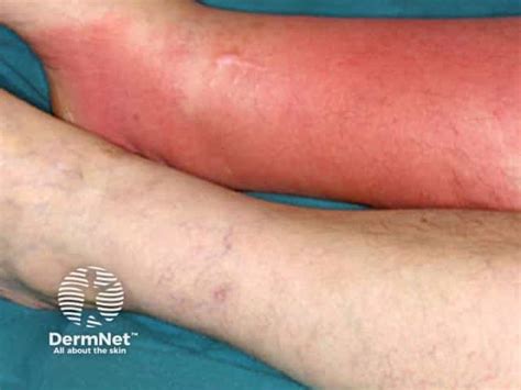 Cellulitis Symptoms Causes Treatment And More Dermnet